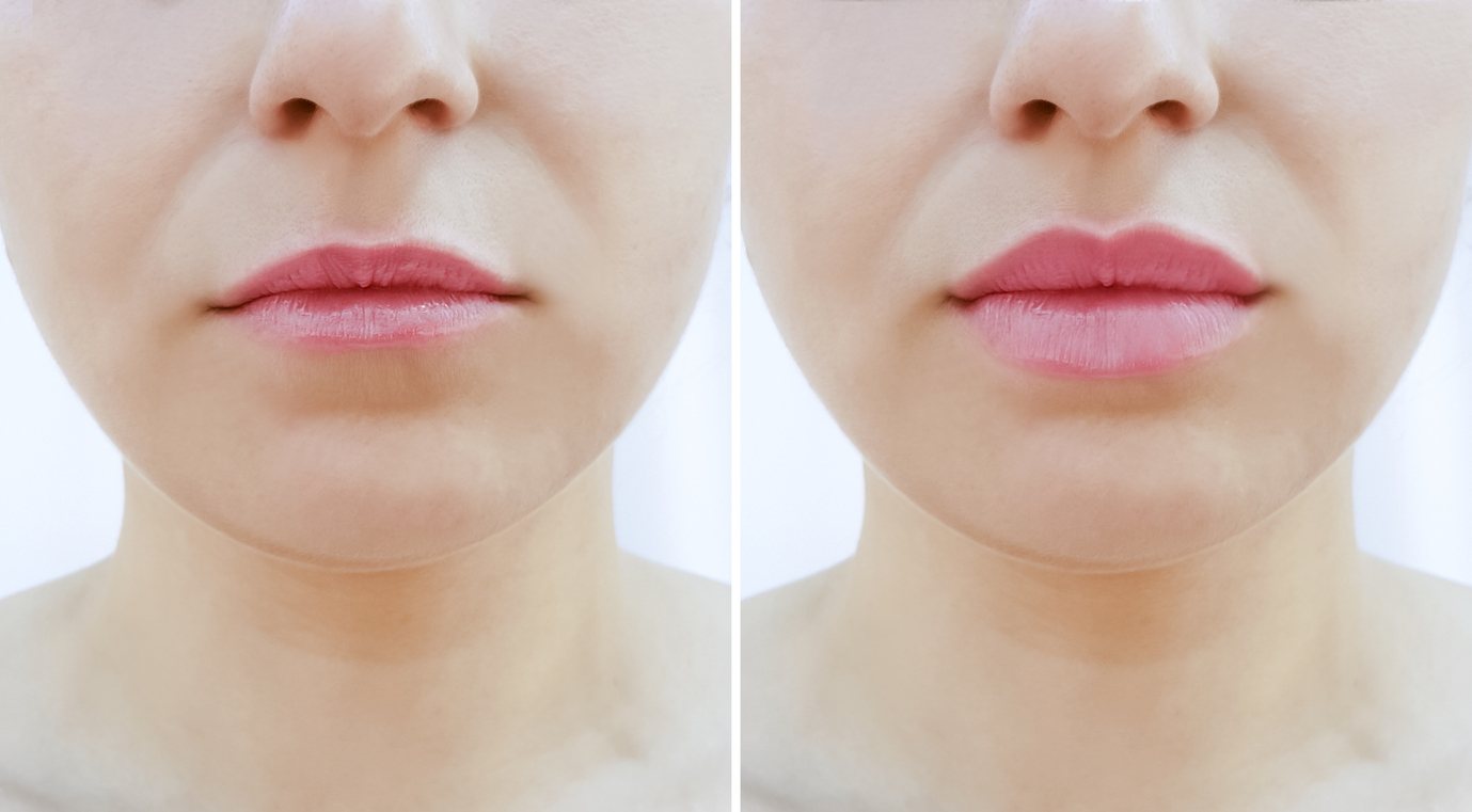 Lip Enhancement - Marvel Medica