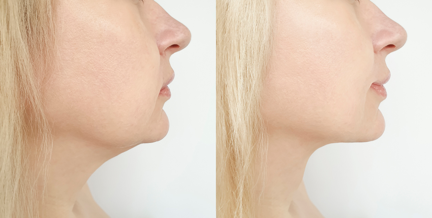 Neck & Chin Contouring - Marvel Medica